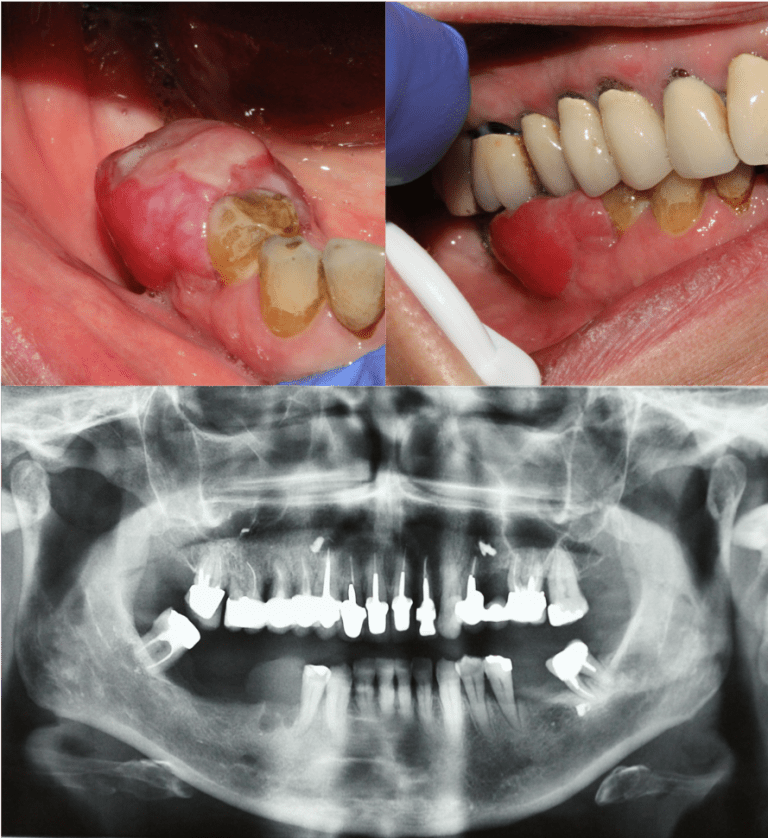 NODULE POST-EXTRACTIONNEL - SFCO