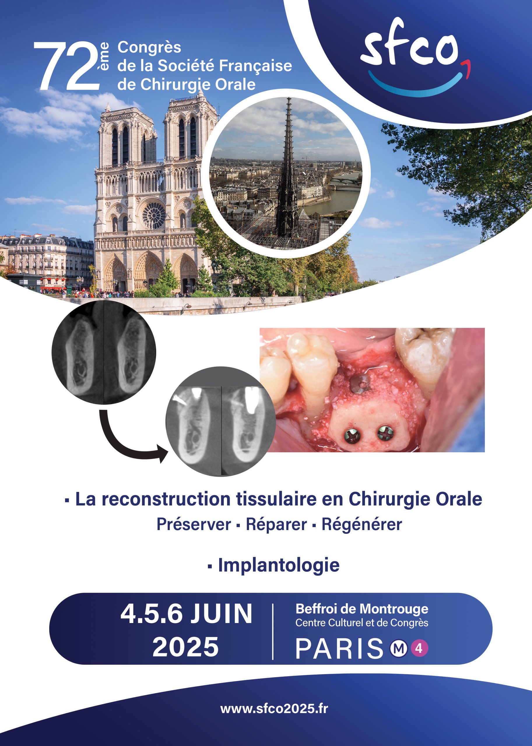 Reconstruction tissulaire en chirurgie orale - SFCO